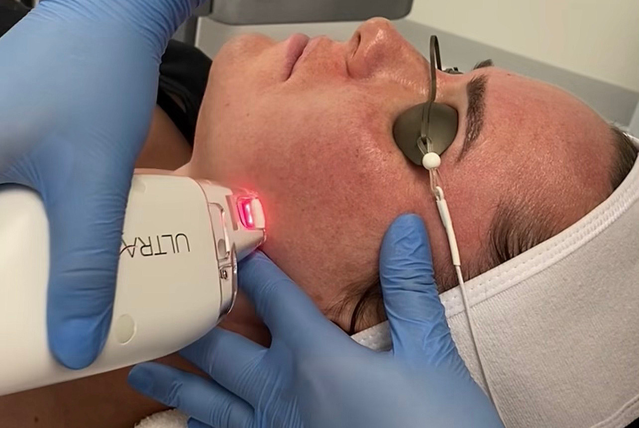 LaseMD Ultra™ Skin Resurfacing Toronto | Redwood Medi Spa