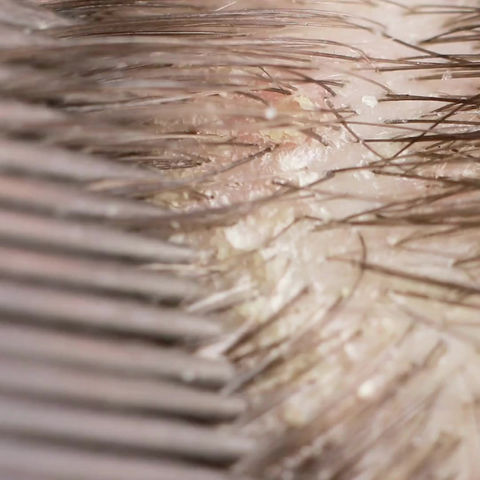 Dry Scalp vs Dehydrated Scalp: Understanding the Difference and How to ...