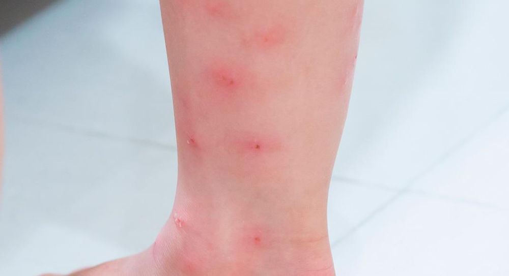 Cómo identificar qué insecto te ha picado