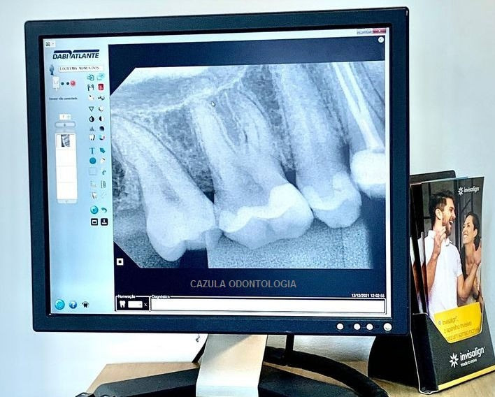 Raio X Digital e suas Vantagens.