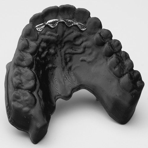 D3D Bonded Retainers | Dean 3 Digital