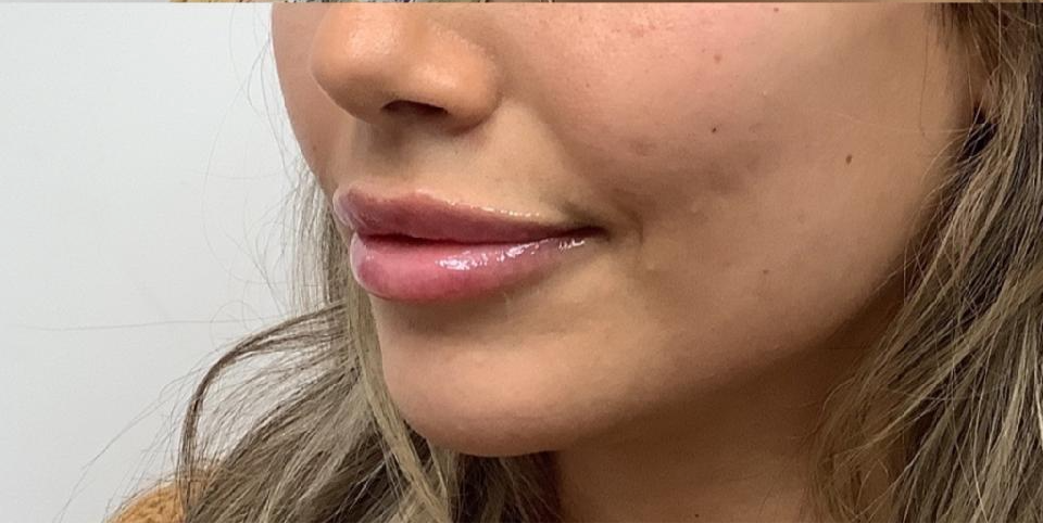 Lip Filler Specialists Near Me | See Our Lip Before/Afters