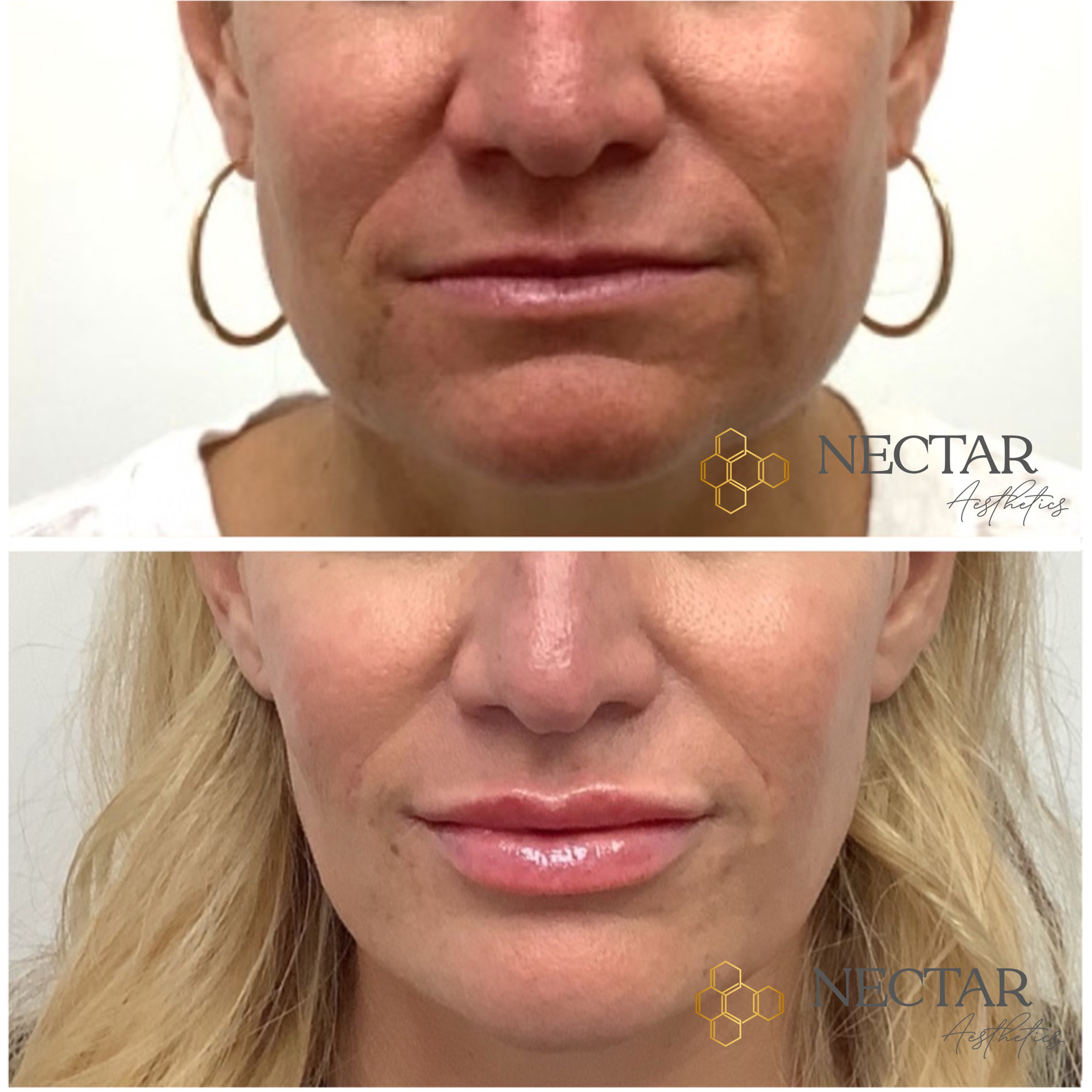 Lip Filler Specialists Near Me | See Our Lip Before/Afters