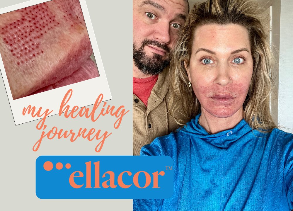 My ellacor™ healing journey (with healing progress photos and tips!)