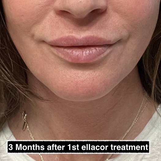 My ellacor™ healing journey (with healing progress photos and tips!)