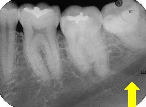 Reborde milohioideo o Línea Oblicua Interna