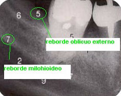 LINEA OBLICUA INTERNA