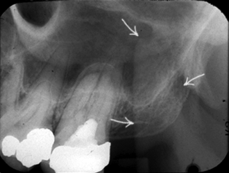 Apófisis Coronoides