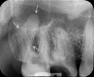 Apófisis Coronoides