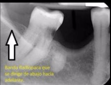 LINEA OBLICUA INTERNA