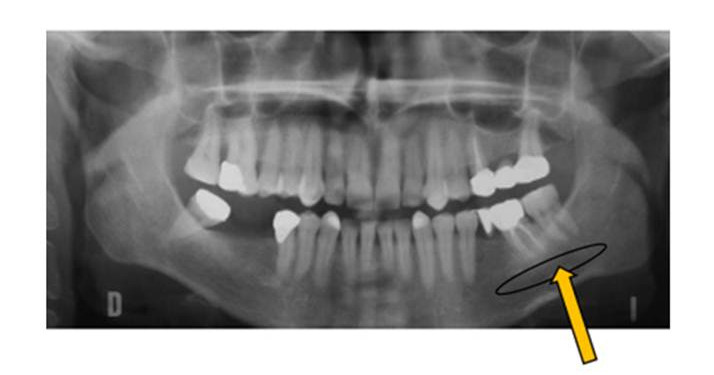 Fosa submandibular
