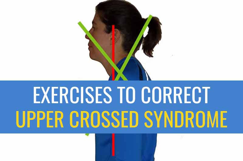 Exercises to correct Upper Crossed Syndrome | Sports Injury Physio