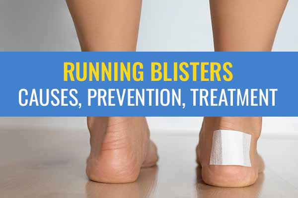 Running blisters – Causes, prevention, and treatment