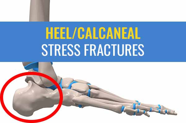 Heel / Calcaneal stress fractures: Causes, symptoms, and treatment Heel / Calcaneal stress fractures: Causes, symptoms, and treatment