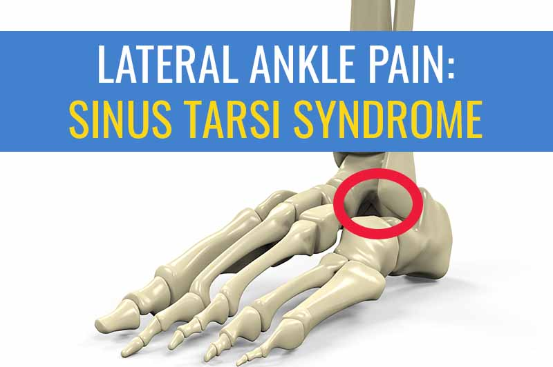 Sinus Tarsi Syndrome as cause of lateral ankle pain | Sports Injury Physio