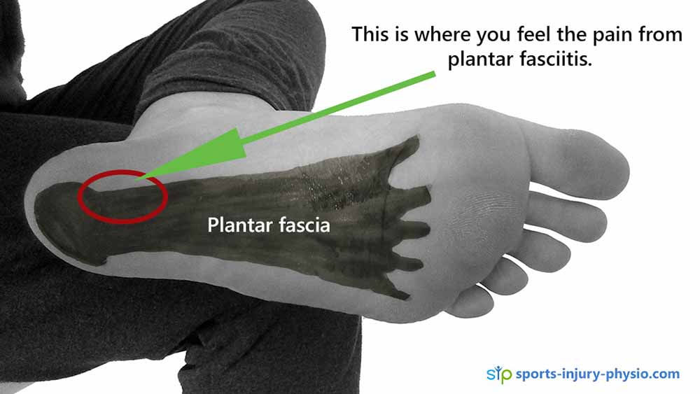 What Causes Plantar Fasciitis? Understanding This Is Key For Treatment