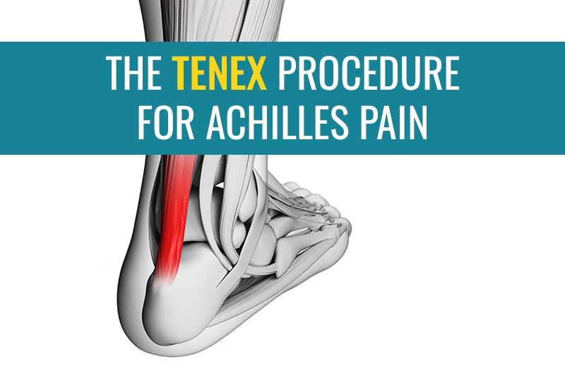 Try this before you have a Tenex procedure for your Achilles tendon