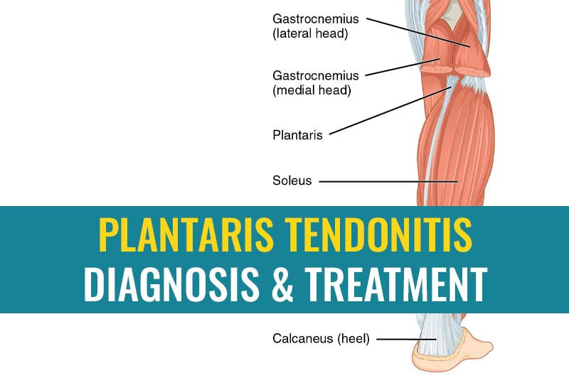 Understanding plantaris tendon pain, how it affects the Achilles, and ...