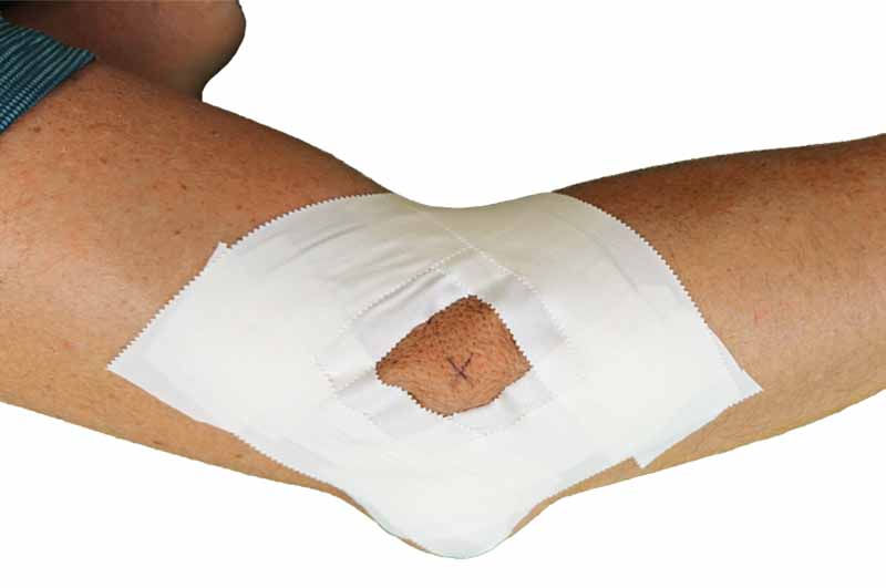Two taping techniques for tennis elbow