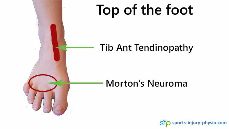 Foot pain in runners - A quick guide | Sports Injury Physio