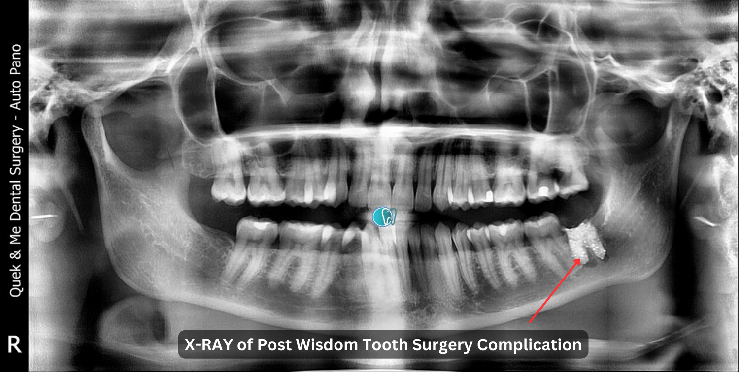 Management of Post-Operative Complications Following Wisdom Tooth ...