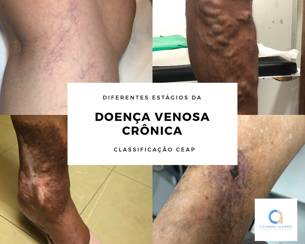 Como classificamos as varizes?