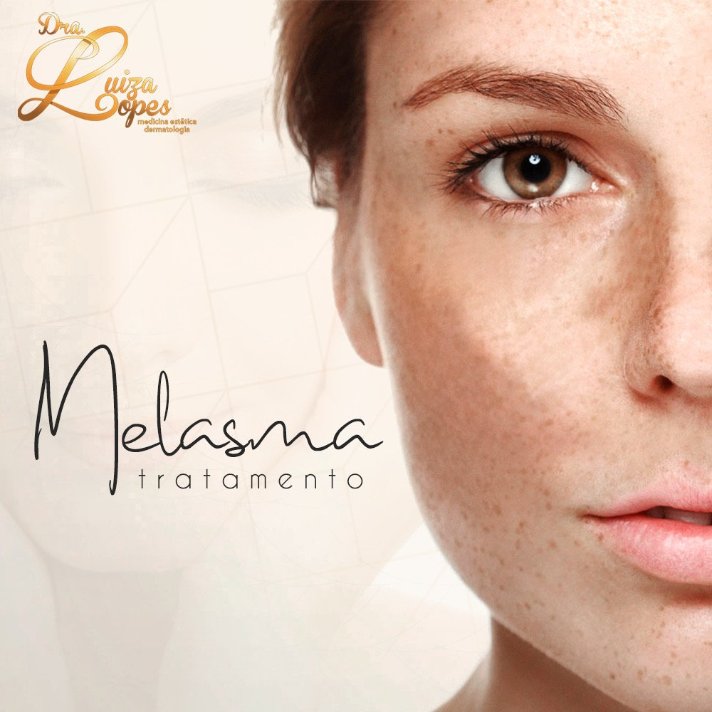 Melasma