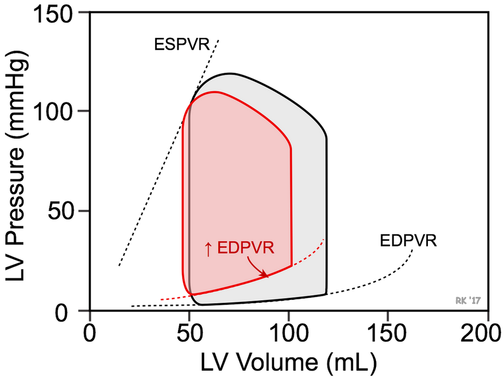 Right Heart Failure: Understanding the hemodynamics - Part 1: Preload