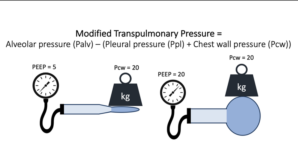 Transpulmonary Pressure: Time to individualize the ventilator.