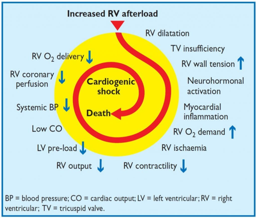 Right Heart Failure: Understanding the hemodynamics - Part 4: Treating ...