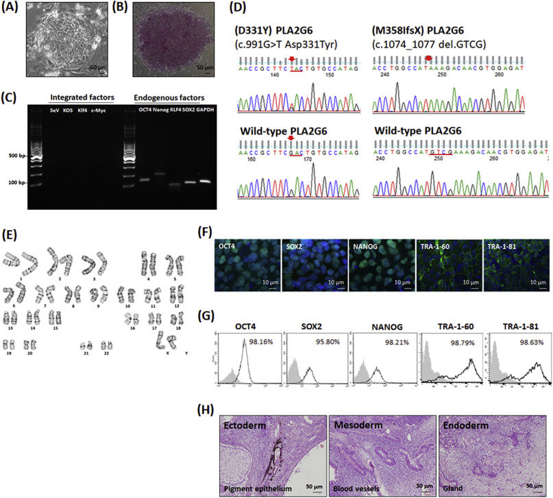 Generation of iPSCs from a young-onset Parkinson's disease patient ...