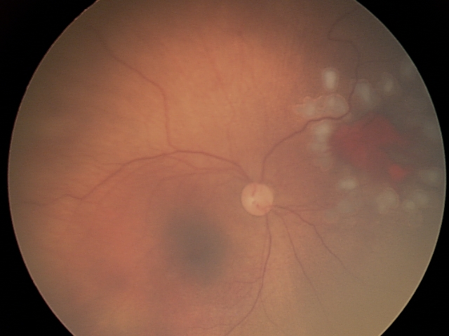 EYE DISEASES | bostoneye