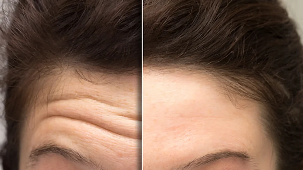 Frown & Forehead Lines: Causes, Prevention, Treatment