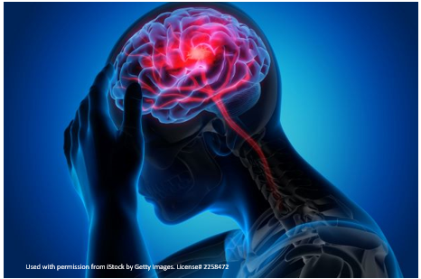 Posterior Circulation Stroke