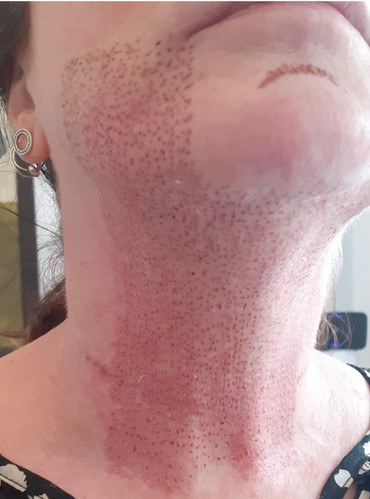 Plasma - Neck and Jowl Lift | Waterloo Plasma