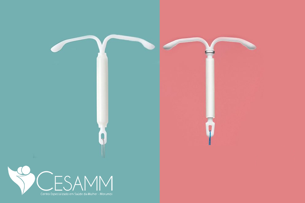 DIU hormonal Kyleena e Mirena, qual a diferença? │ Profª Dra Patricia ...