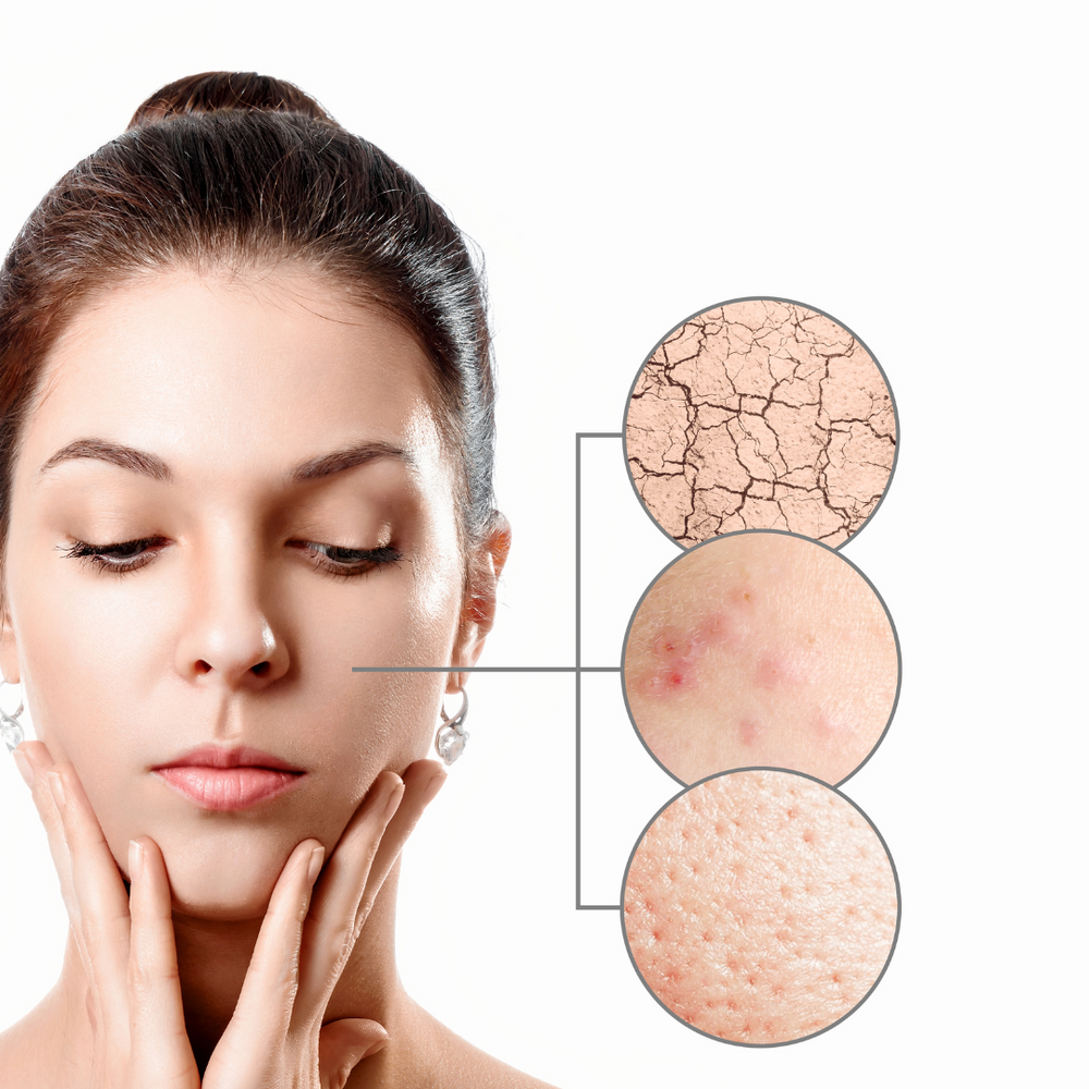 Acné solutions | Visage | Boutons et aloe vera | Forever France Guadeloupe
