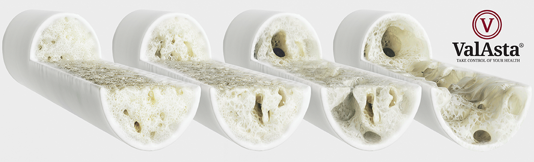 ValAsta for Osteoporosis II
