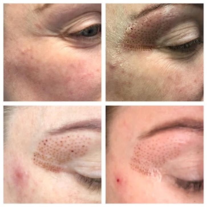 FIBROBLAST PLASMA SKIN TIGHTENING | lmstudioink