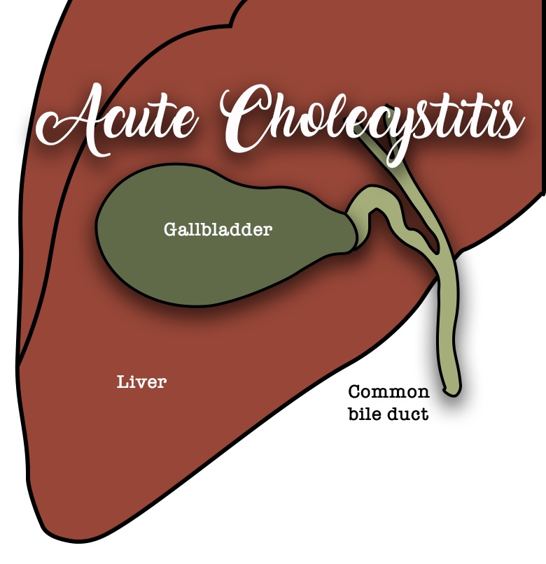Acute Cholecystitis