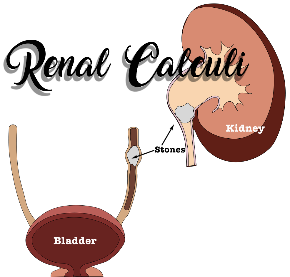 Renal Calculi
