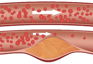 Hyperlipidemia