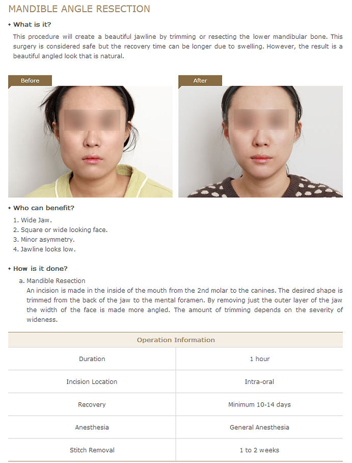 MANDIBLE ANGLE RESECTION