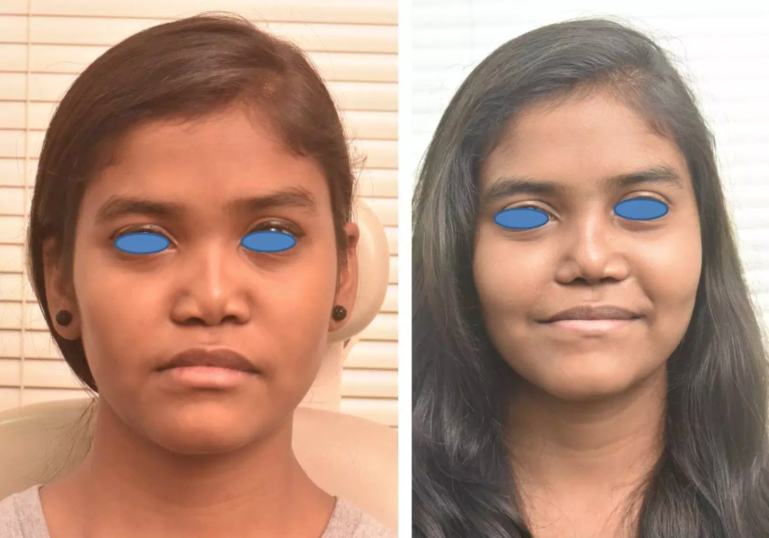 Binder’s Syndrome Nose deformity: Rhinoplasty