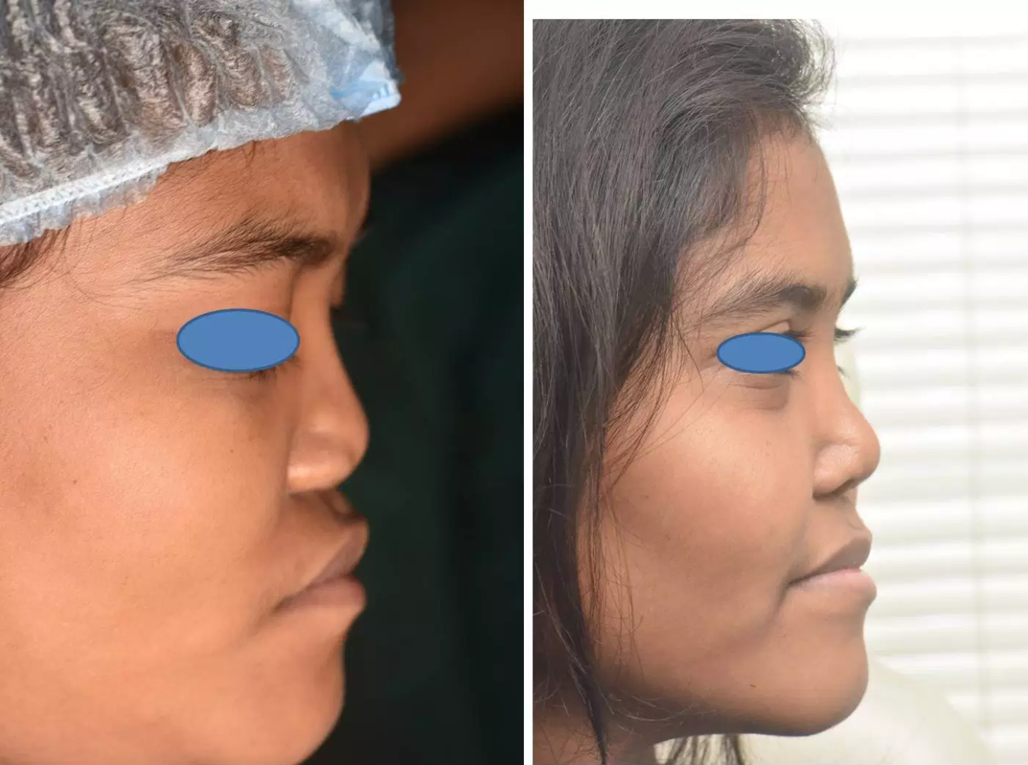 Binder’s Syndrome Nose deformity: Rhinoplasty