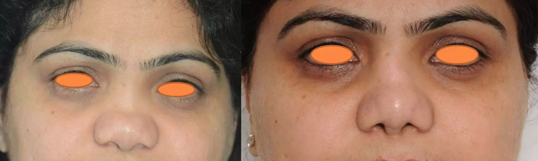 Binder’s Syndrome Nose deformity: Rhinoplasty