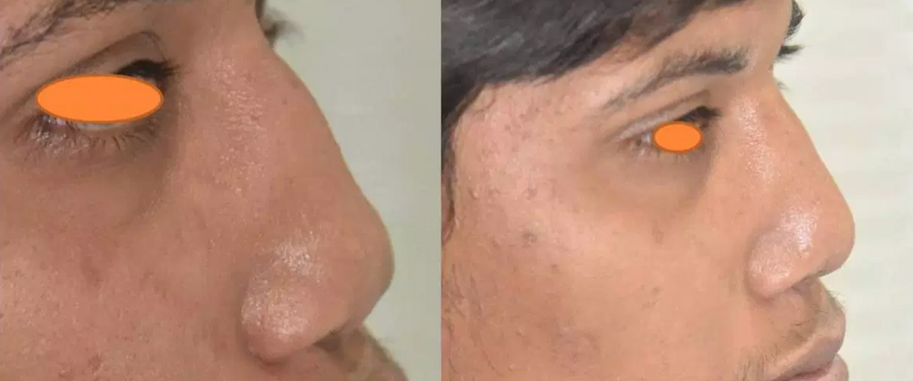 Binder’s Syndrome Nose deformity: Rhinoplasty