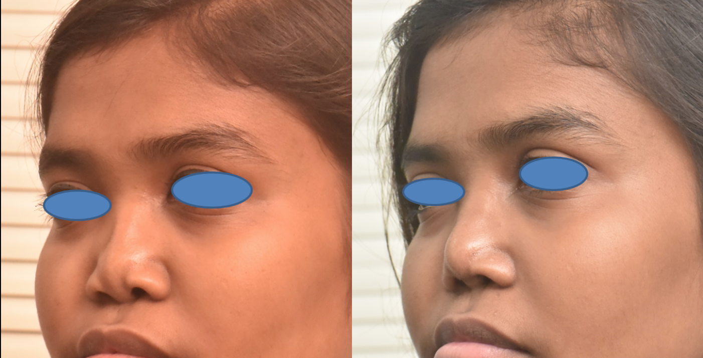 Binder’s Syndrome Nose deformity: Rhinoplasty
