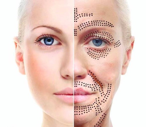 High-Frequency Plasma Skin Regeneration | Advanced Aethetics