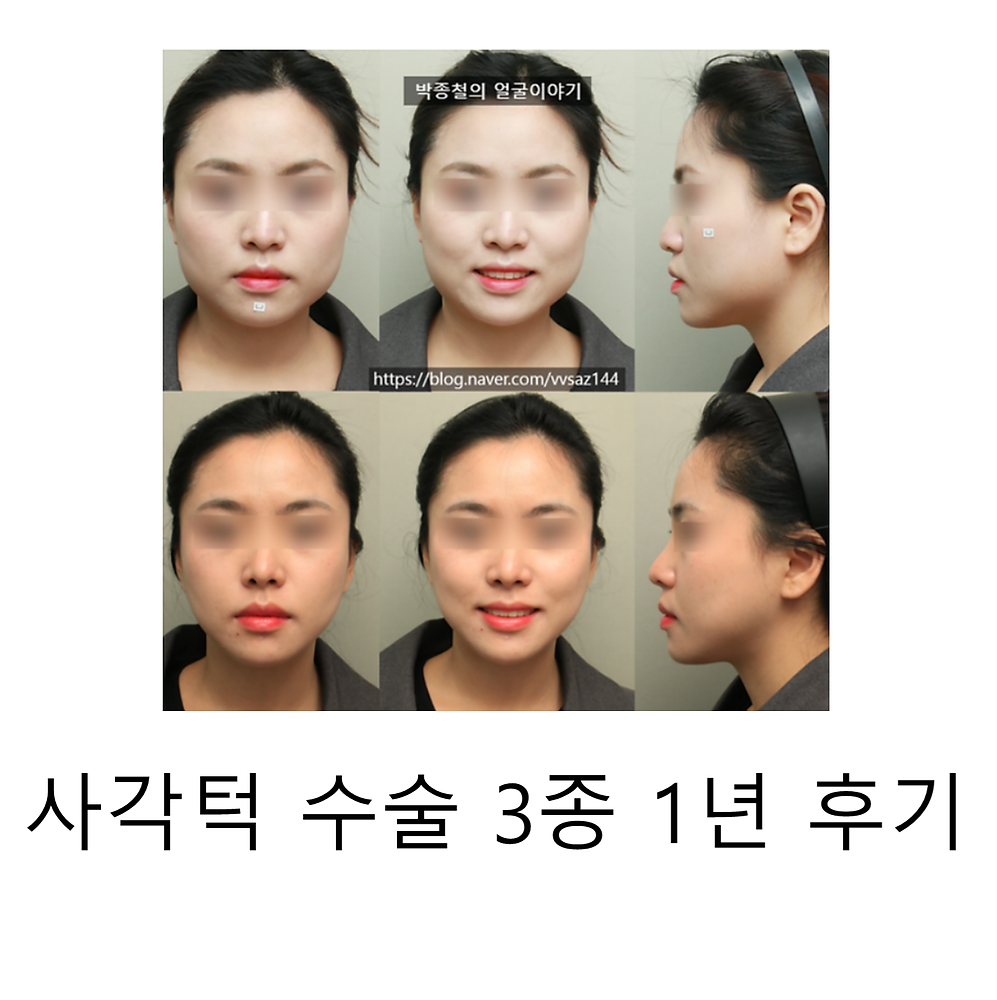 1-Year Jaw Reduction Surgery Review: Mandibular Angle, Cortical Bone ...